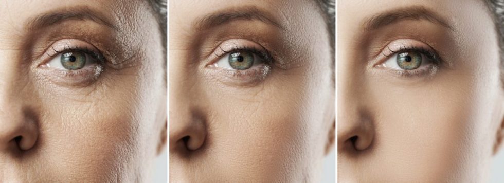 Faltenbehandlung mit Kollagen-Booster ELLANSÉ™ - Ana Wimmer Medical ...