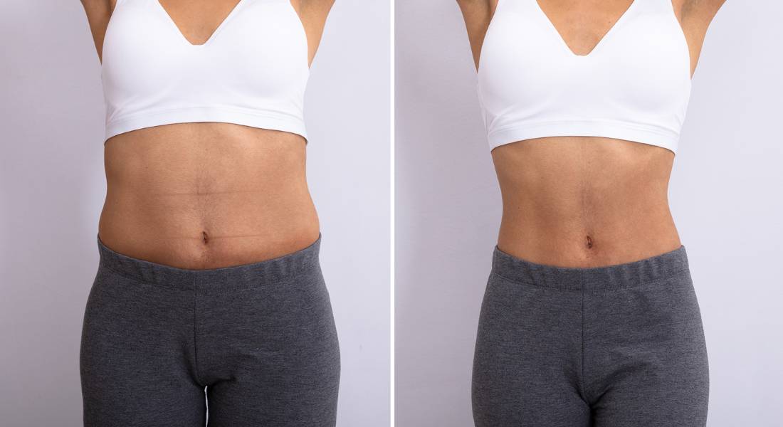 Fett Weg Spritze Vorher Nachher Bauch